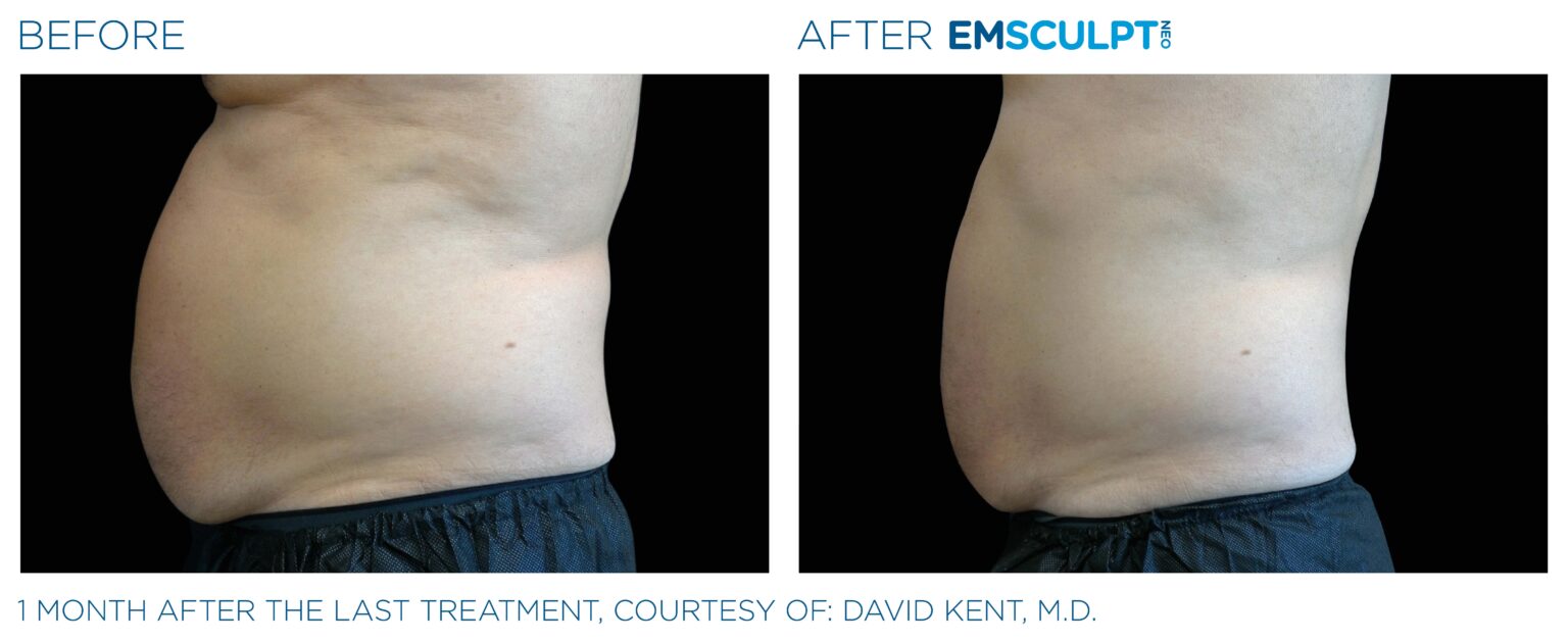 Core-To-Floor Part 2: The EMSCULPT NEO | Men's Health Boston