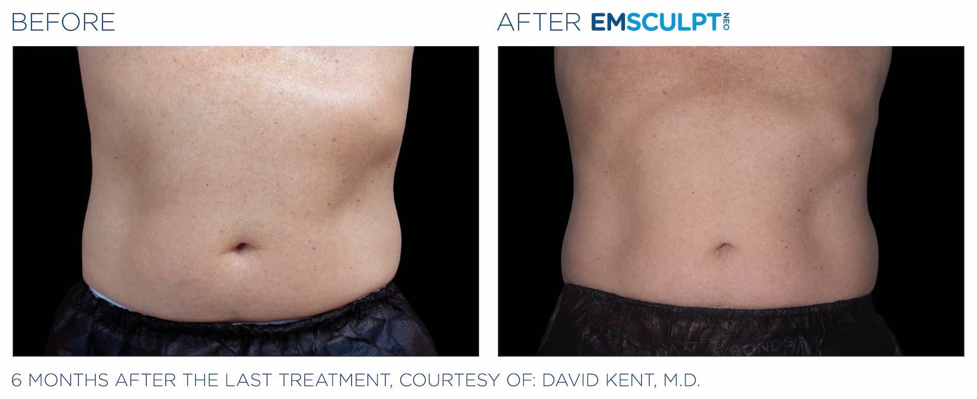 EMSCULPT NEO | Men's Health Boston
