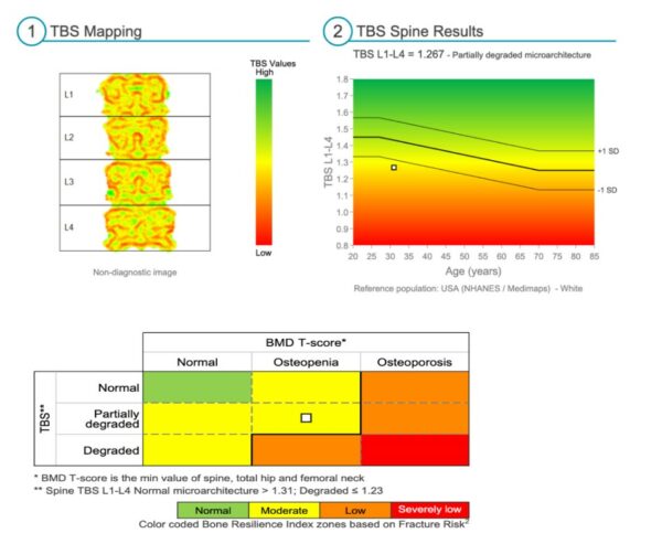 How Do I Read a DXA Bone Density Report? | Men's Health Boston